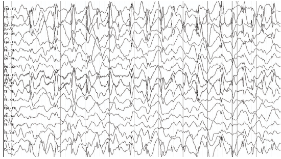 Self-Limited Focal Epilepsies in Childhood