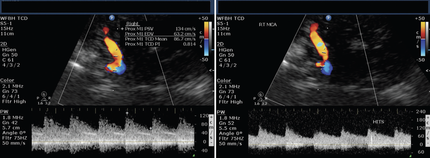 Stroke in a Young Adult:Immunomodulation-Responsive Bilatera