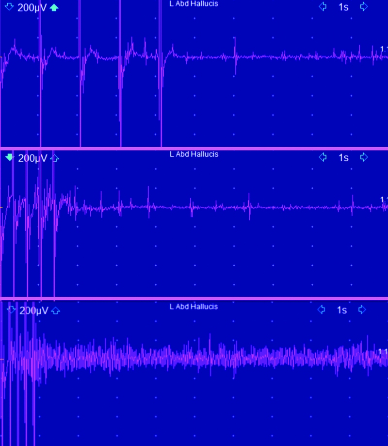 Diagnosis and Management of Muscle Cramps
