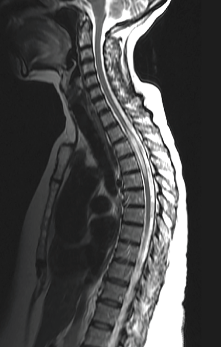 Case Report: Longitudinally Extensive Transverse Myelitis