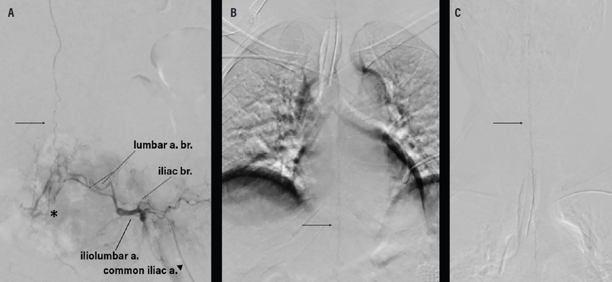Case Report: Occult Spinal Dural Arteriovenous Malformation