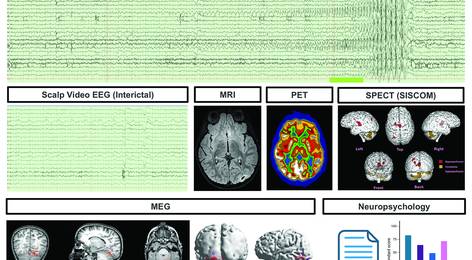 Epilepsy Essentials: Insular Epilepsy