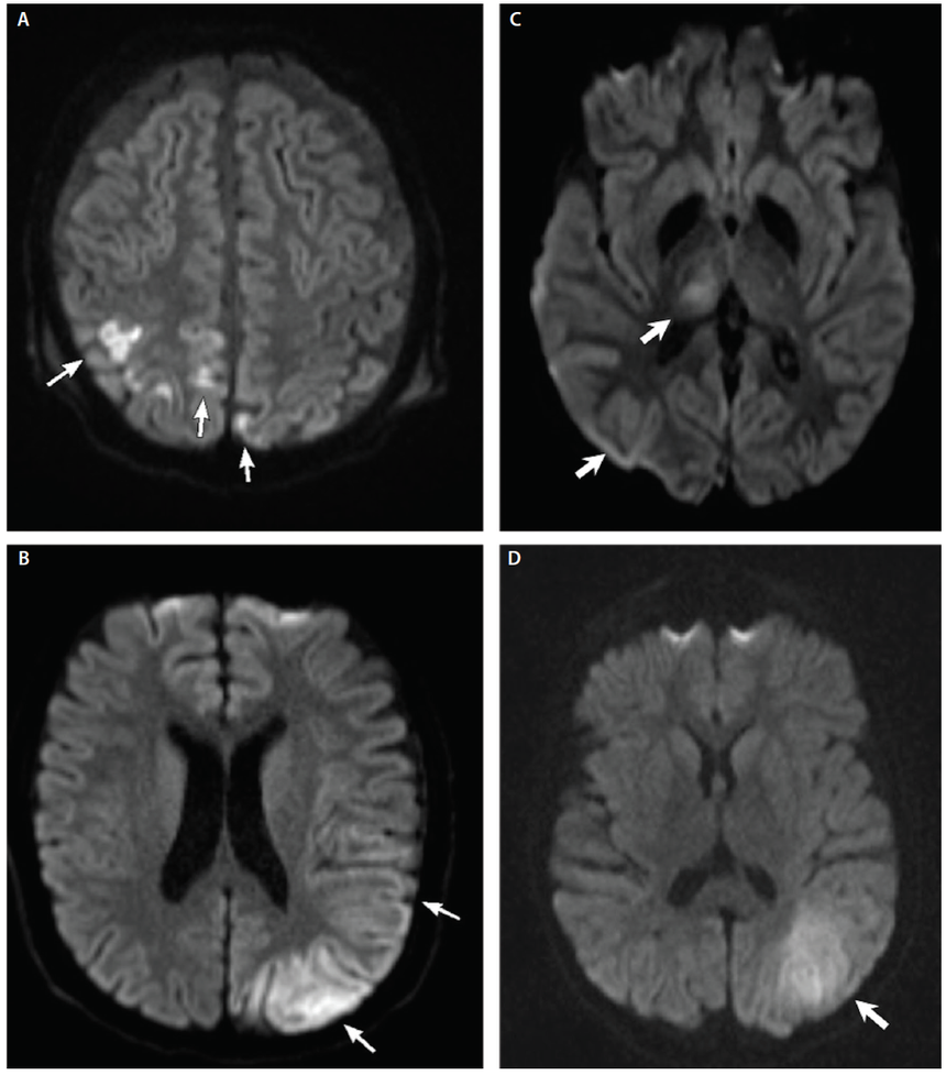 Stroke Snapshot: Metabolic Stroke