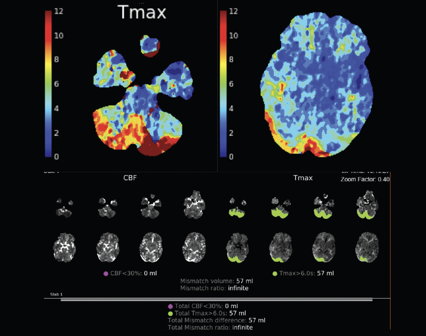 Bilateral Vertebral Artery Dissection and Occlusion After a