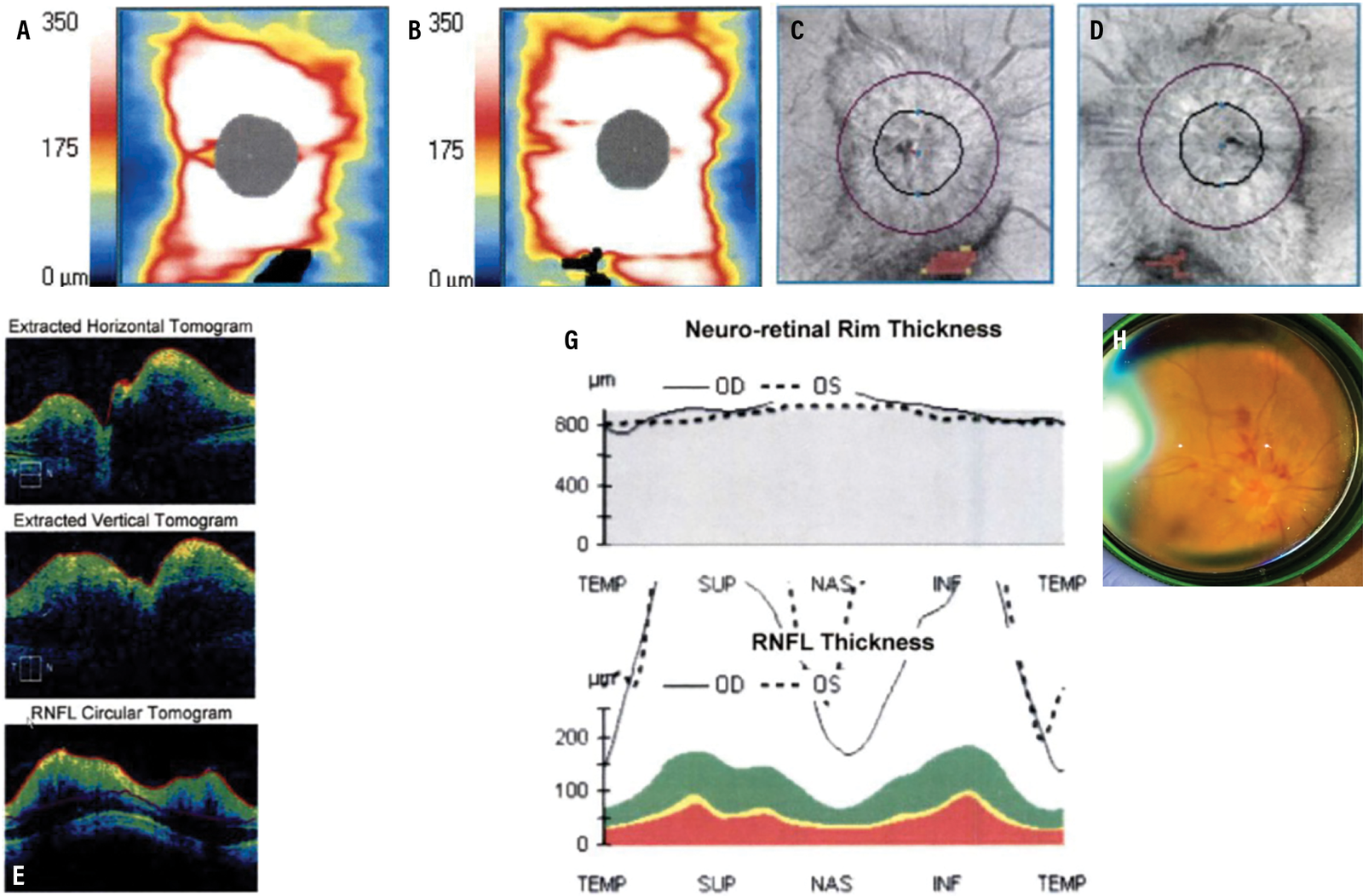 Direct Neural Invasion A Mechanism for CLL