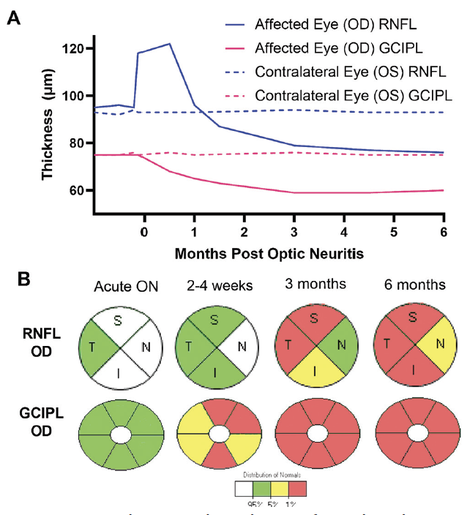 MS Minute: Retinal Optical Coherence Tomography for MS