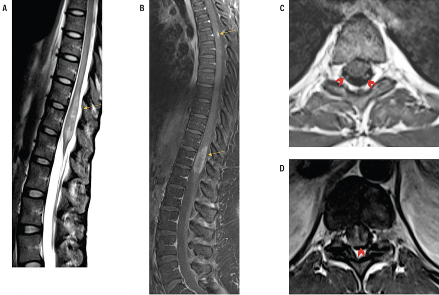 Neuromyelitis Optica Spectrum Disorder With Atypical Imaging