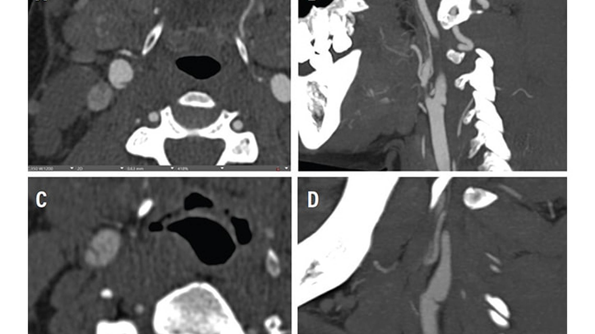 Stroke Snapshot: Carotid Artery Webs—Epidemiology and Pathop