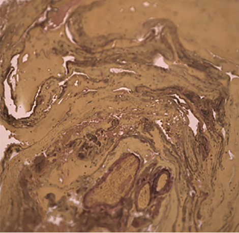 Case Report: Complete Spinal Cord Injury