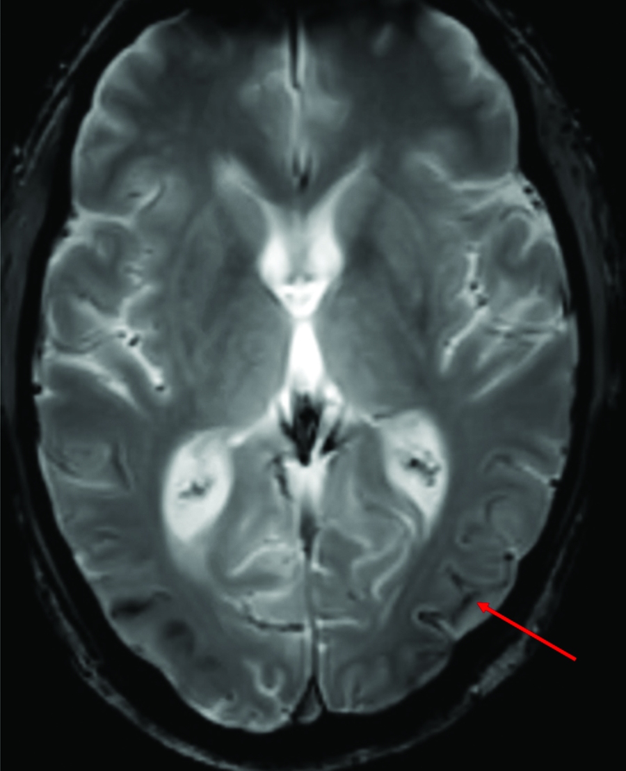 Triaging Symptomatic Amyloid-Related Imaging Abnormalities