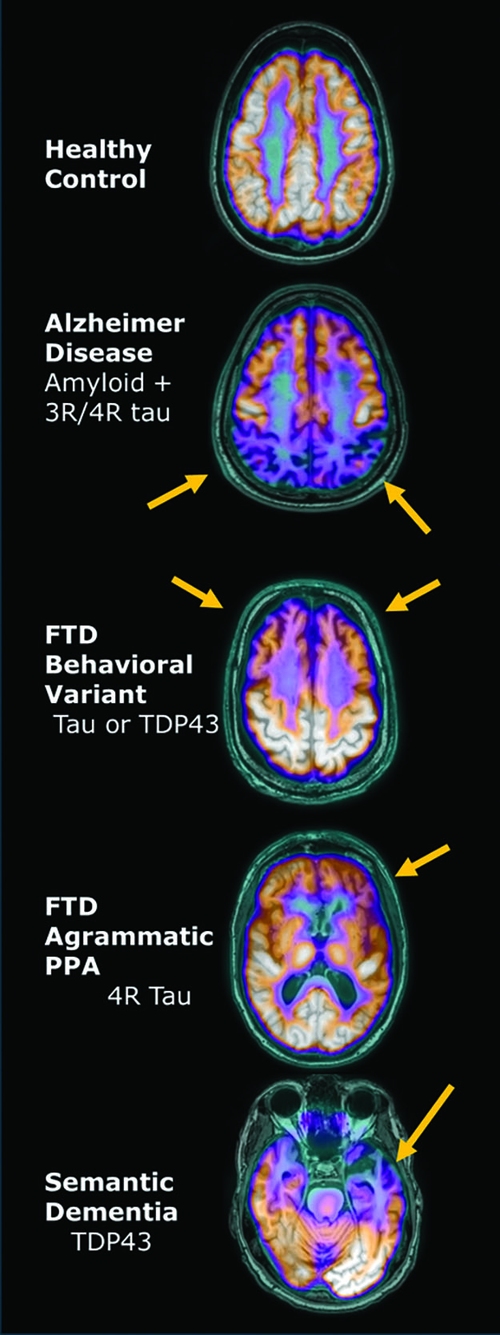neuroimaging biomarkers in alzheimer disease & dementia
