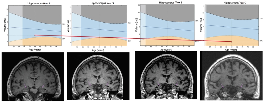 Quantitative Structural MRI for Neurocognitive Disorders