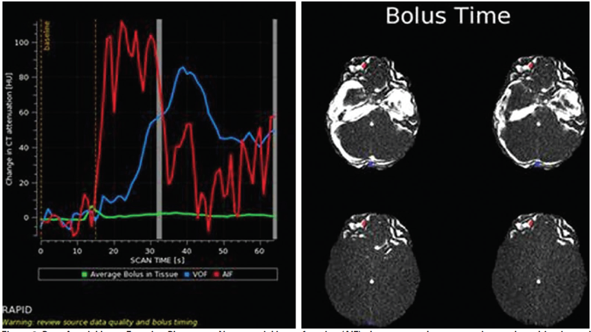 RAPID Automated CT Perfusion in Clinical Practice