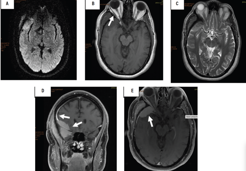 Sphenoid Wing Meningioma Presenting With a Temporal Fossa Ma