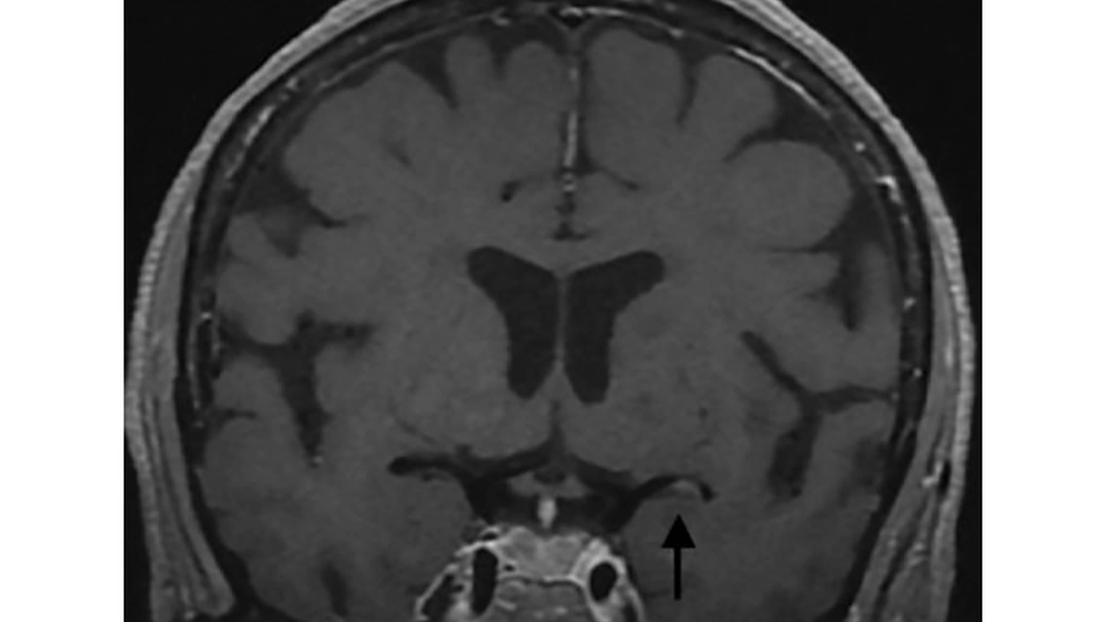 Stroke Snapshot: Intracranial MRI Vessel-Wall Imaging