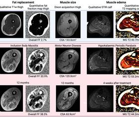 Differential Diagnosis of Distal Myopathies