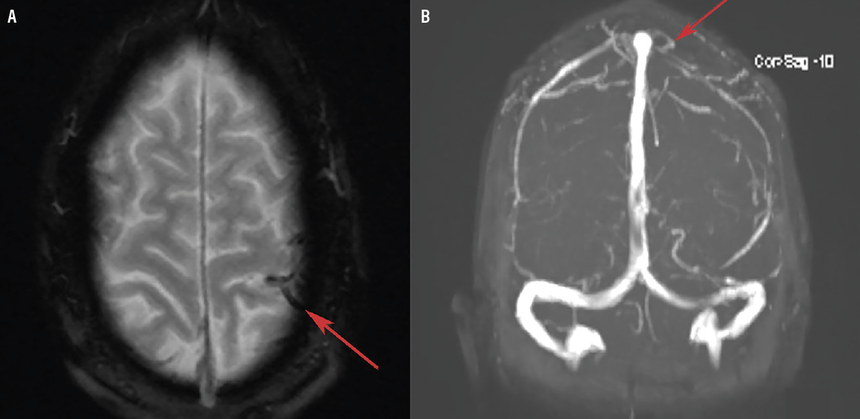 Stroke Snapshot: Ulcerative Colitis & Stroke