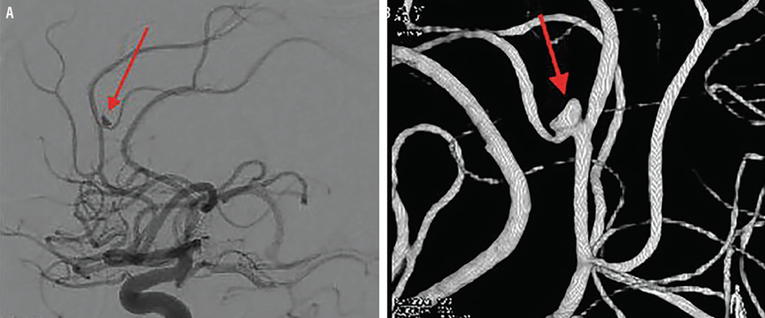 Case Report: Cerebral Aneurysm Rerupture