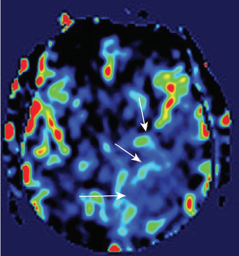 Special Report: Neuro-oncology