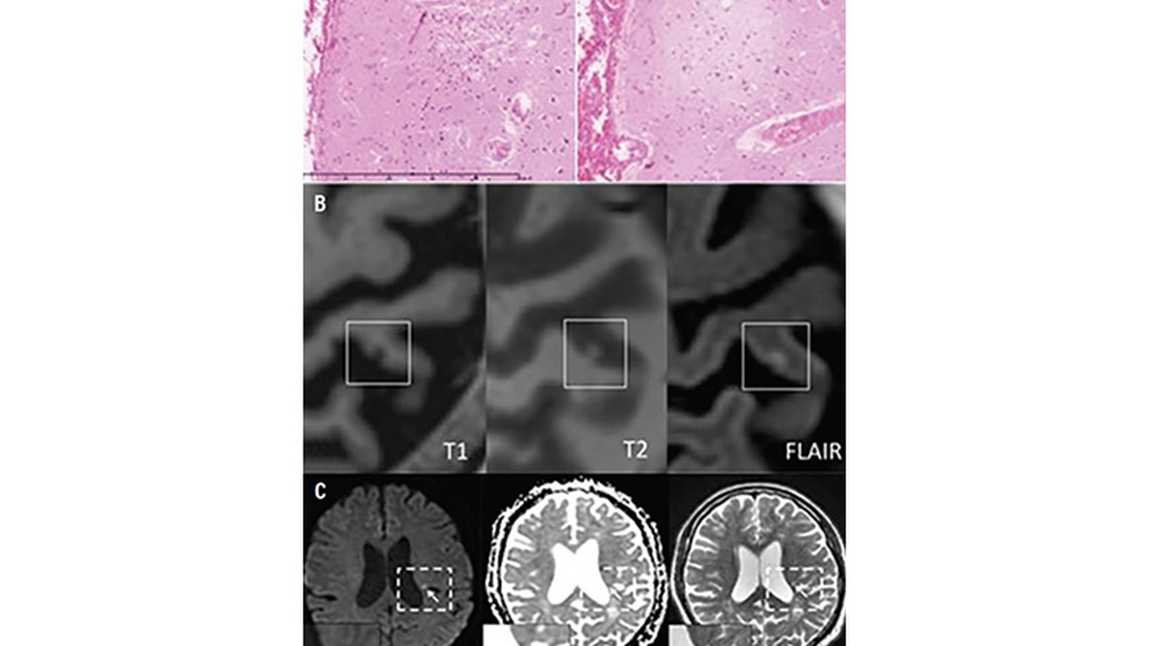 Stroke Snapshot: Cerebral Microinfarcts—Etiology and Clinica