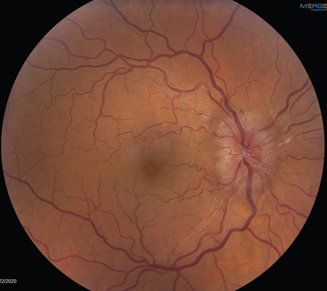 Pseudotumor Cerebri Syndrome Related to a Dural Arteriovenou