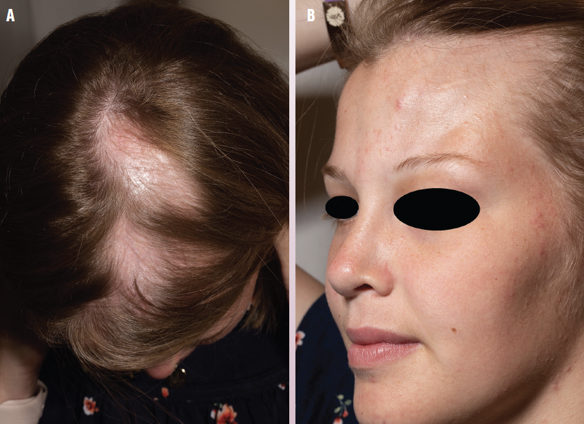 Parry-Romberg Syndrome With Drug-Resistant Epilepsy