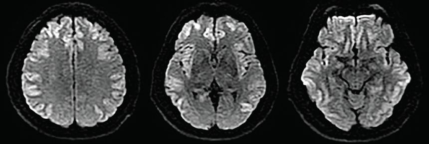 Hyperammonemic Crisis