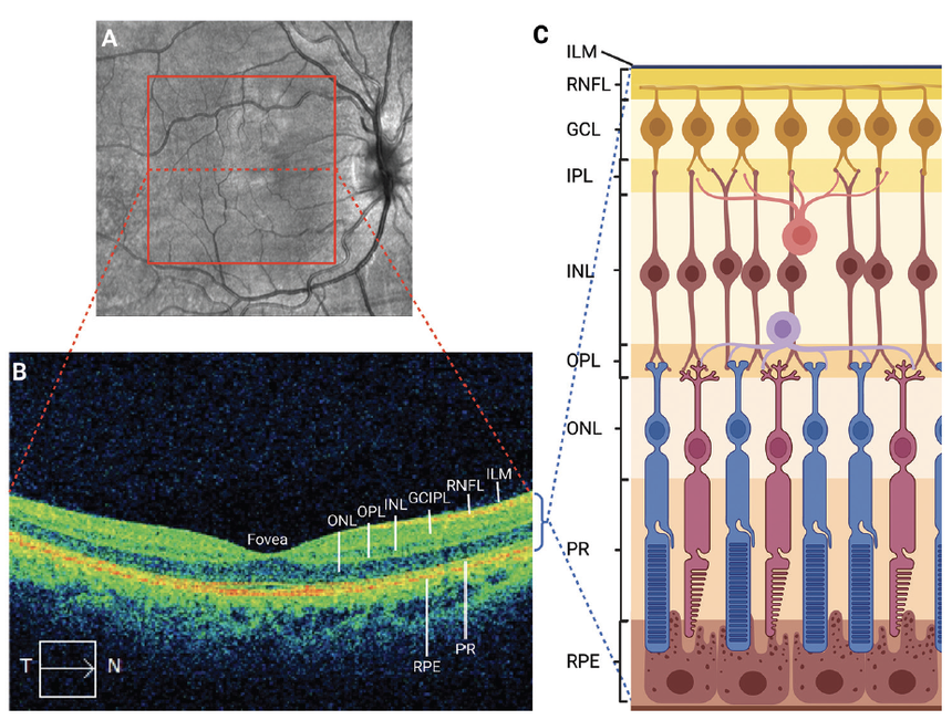 MS Minute: Retinal Optical Coherence Tomography for MS