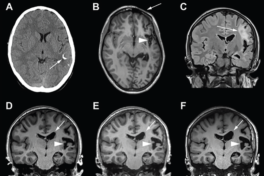 Parry-Romberg Syndrome With Drug-Resistant Epilepsy