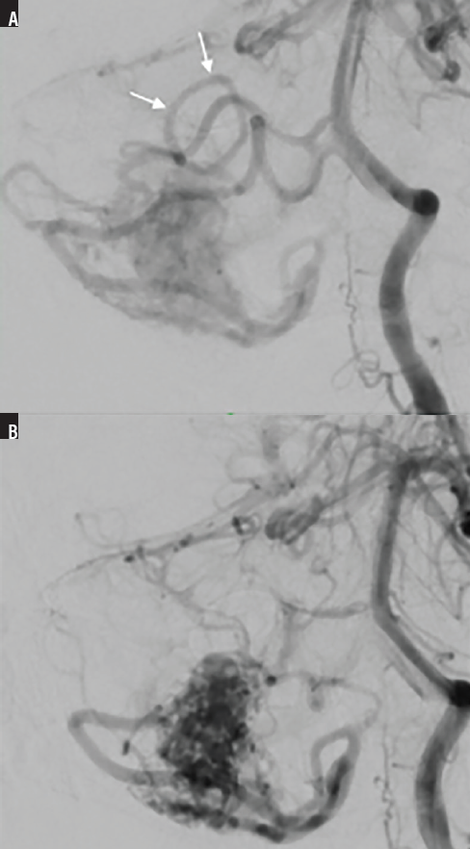 Arteriovenous Malformations & Trigeminal Neuralgia
