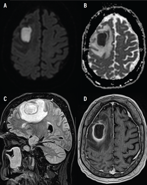 Intracranial Infections: Bacterial, Viral, Fungal, Parasitic
