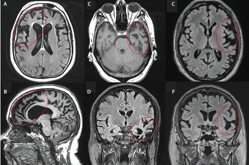Frontotemporal Dementias