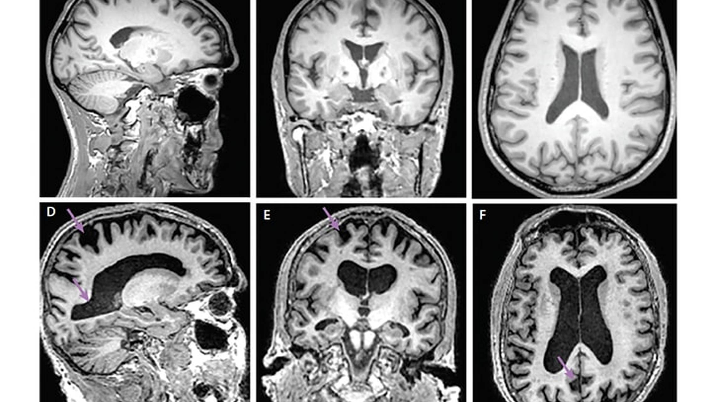Neuroimaging and Alzheimer’s Disease