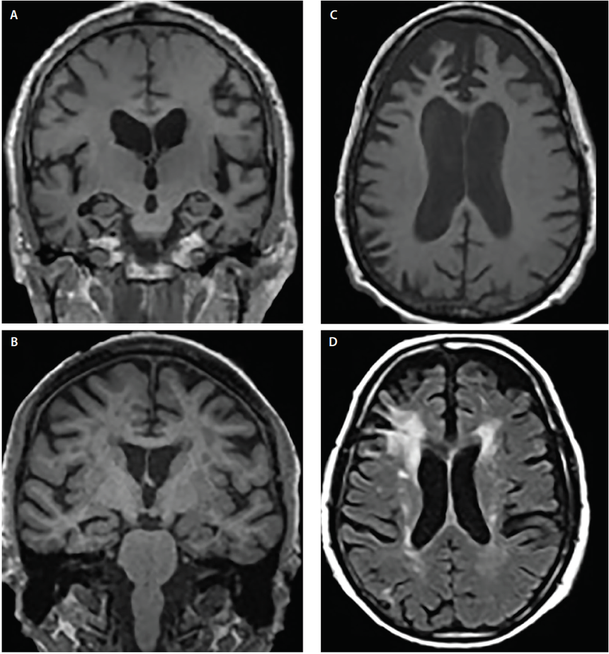 Brain Imaging in Differential Diagnosis of Dementia