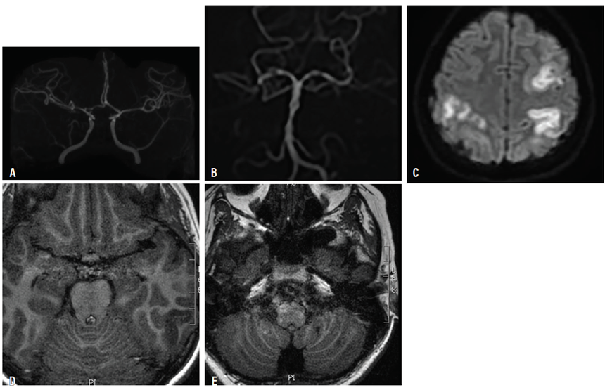 Stroke Snapshot: Intracranial MRI Vessel-Wall Imaging
