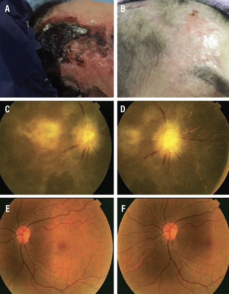 Ischemic Complications from a Facial Lipofilling Procedure
