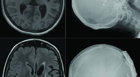 Epilepsy Essentials: Insular Epilepsy