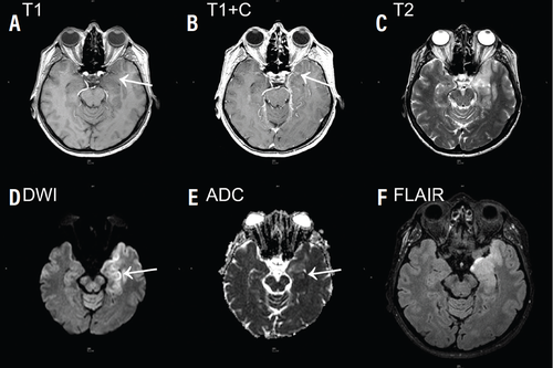 Intracranial Infections: Bacterial, Viral, Fungal, Parasitic