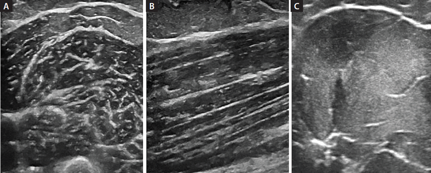 Ultrasound in Neuromuscular Medicine