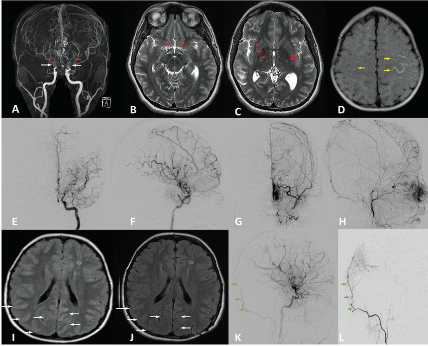 Moyamoya Disease