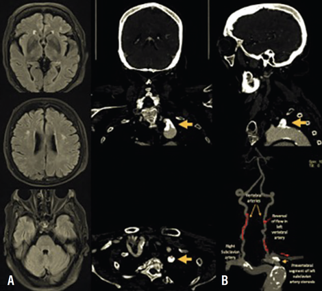 An Unusual Case of a Vertebrobasilar Transient Ischemic Atta