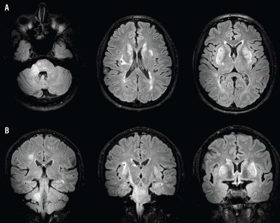 Acute Encephalopathy With Unusual Brain Lesions