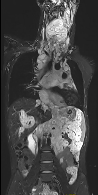 Care of Individuals with Neurofibromatosis Type 1