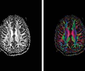 Postural Orthostatic Tachycardia Syndrome
