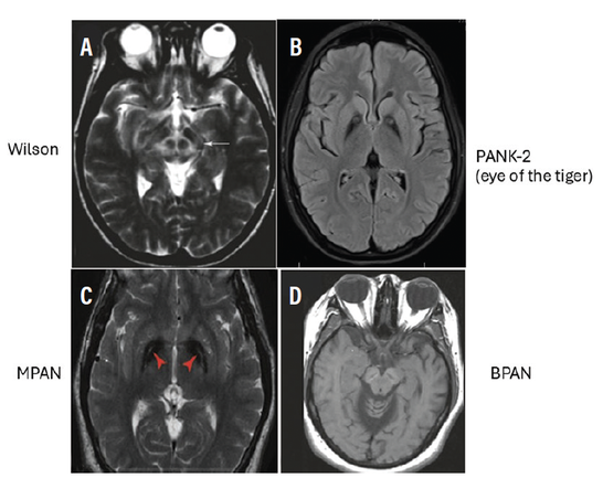 Understanding Dystonia: Diagnosis and Management