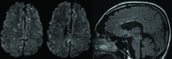 Immune Stroke: Inflammatory Cerebrovascular Disorders
