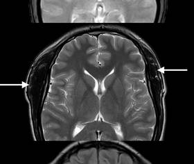 Headache Horizons: Recognition, Diagnosis, and Treatment of