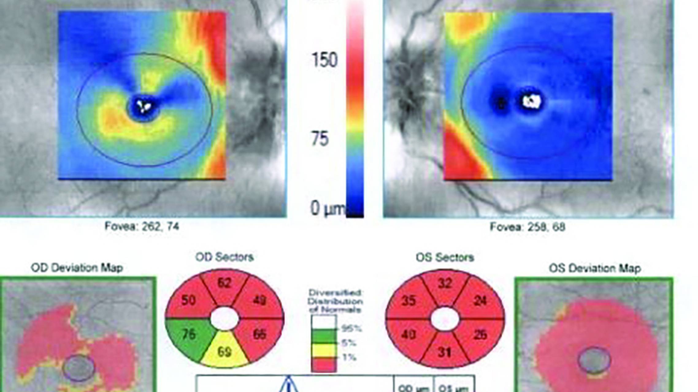 Paraclinical Optic Nerve Tests in Multiple Sclerosis