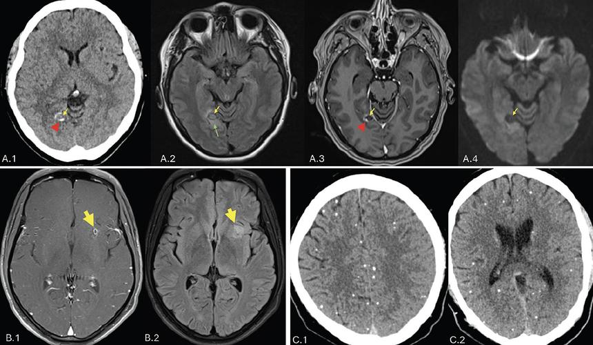 Neurologic Complications of Globally Prevalent Infectious Di