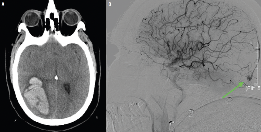 Spontaneous Intracranial Hemorrhage Secondary to Rare Pial A